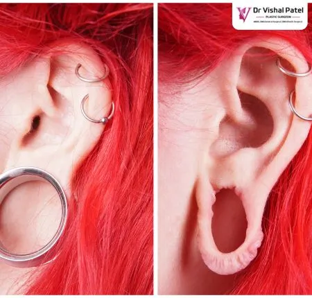 Best Ear Lobe Repair in Mumbai - Flat 30% Off on Surgery